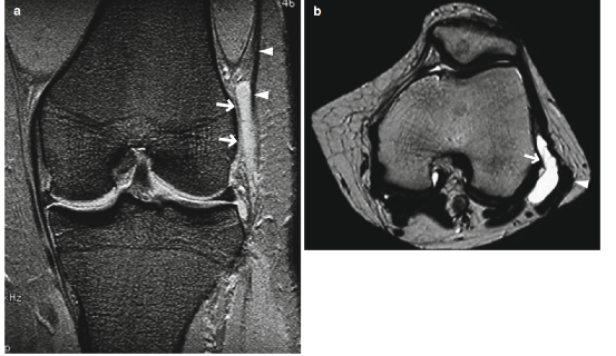 膝关节滑囊和滑囊炎磁共振表现 - 知乎