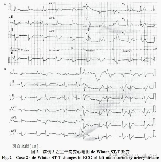 对心电图de Winter ST-T改变的思考 - 知乎
