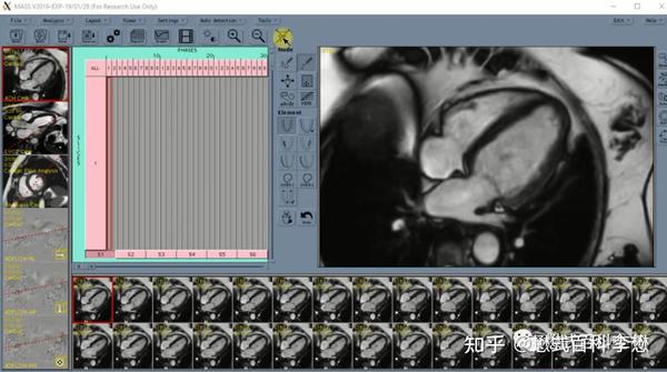4D-Flow扫描数据采集：序列及参数 - 知乎