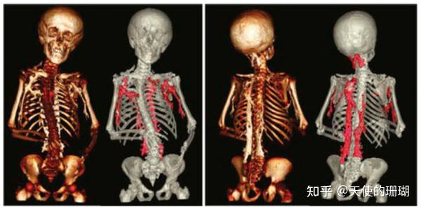FOP中异位骨(HO)的影像学模拟评估方法 - 知乎