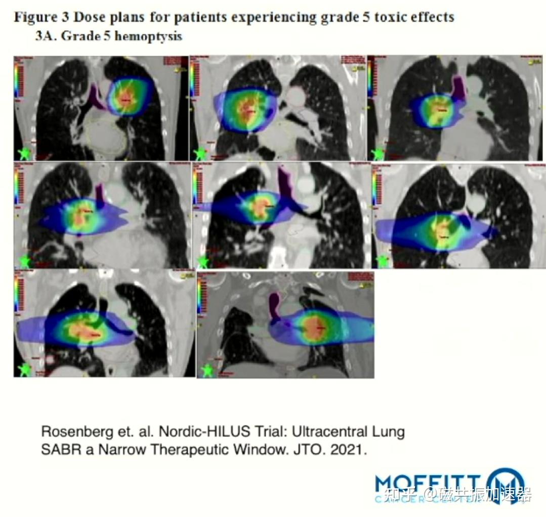 “穿针引线”-磁共振引导的中央、超中央型肺癌放射消融治疗 - ViewRay MRIdian - 知乎