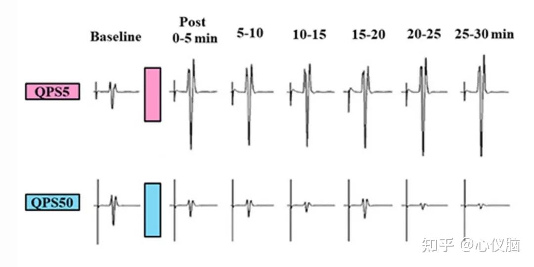 重复经颅磁刺激新方向——四脉冲刺激（QPS） - 知乎