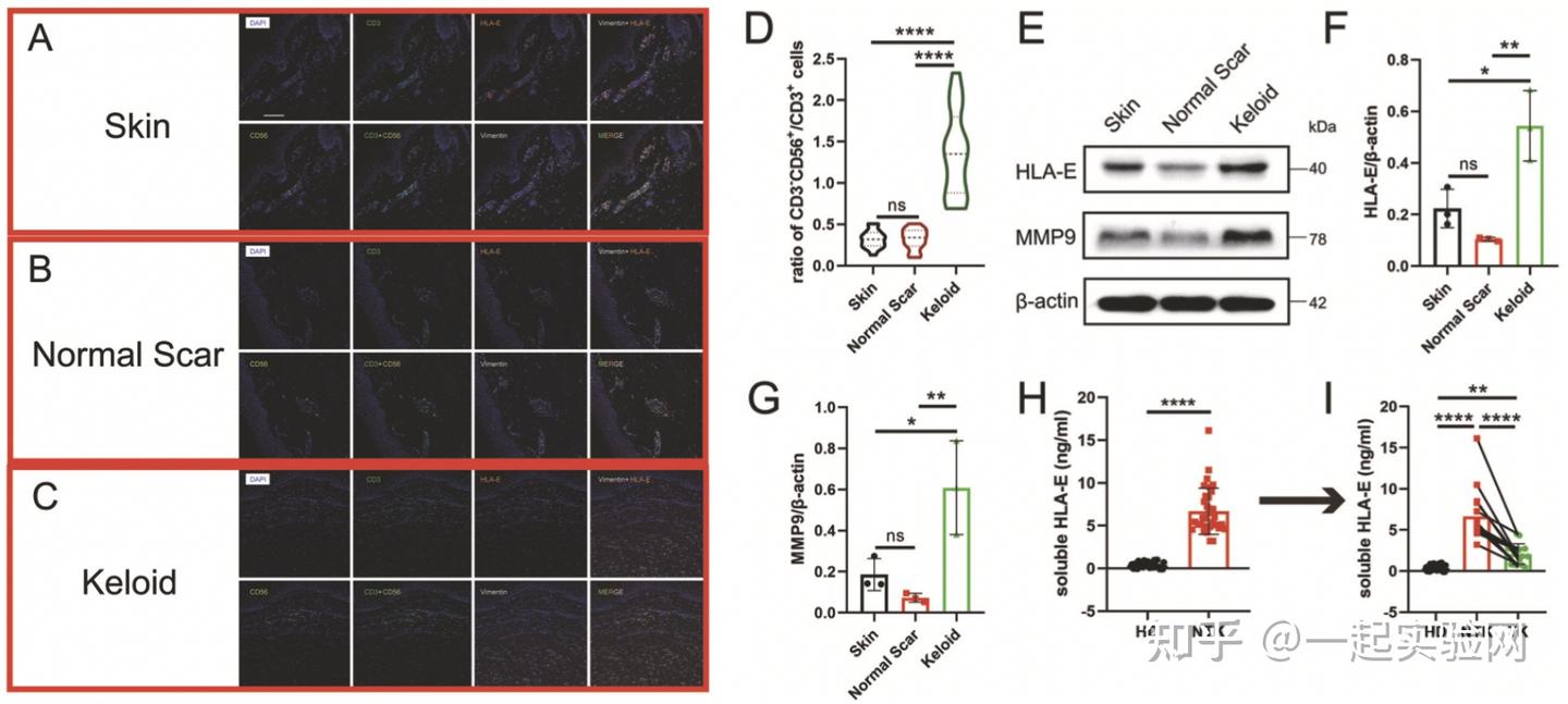 下调的细胞毒性CD8+T细胞与NKG2A-sHLA-E 轴作为瘢痕疙瘩的预测性生物标志物和潜在治疗靶点 - 知乎