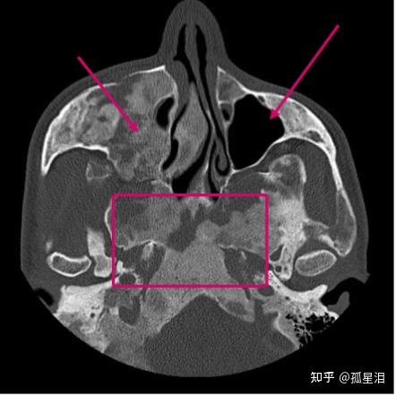 【罕见病】埃及狮身人面像的原型？骨性狮面症（Leontiasis ossea） - 知乎