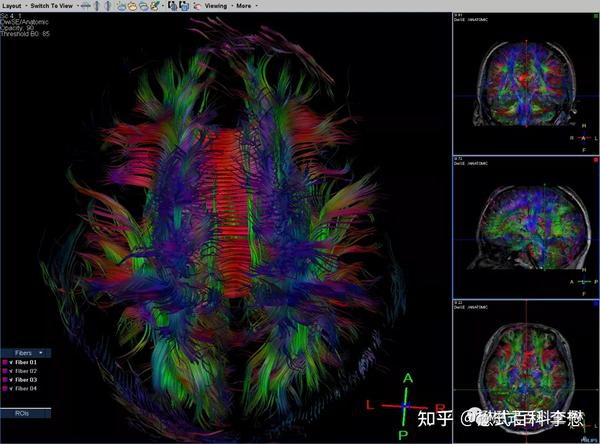 DTI技术原理及临床应用 - 知乎