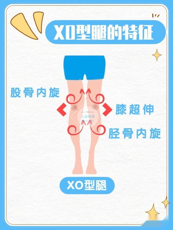 【体态调整】一张图搞懂XO型腿，附改善方案 - 知乎