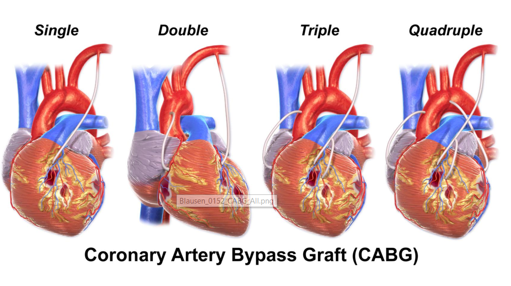 药剂师学习笔记之冠心病（Coronary Artery Disease, CAD）和动脉粥样硬化（Atherosclerosis） - 知乎