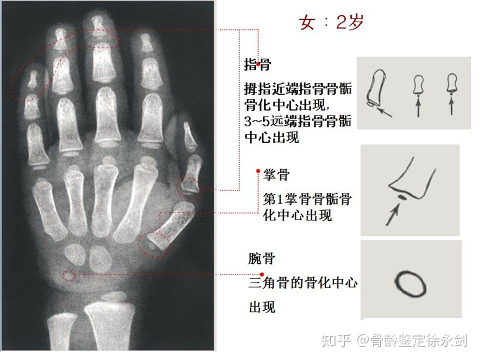 详解骨龄标准G-P骨龄图谱法（女孩版） - 知乎