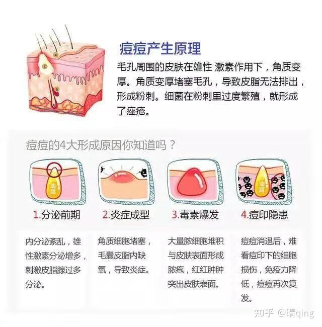 祛痘！祛痘抗争史！！！ 知乎
