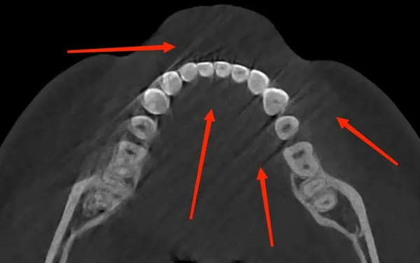 不可避免的CBCT运动伪影，到底如何改善？ - 知乎