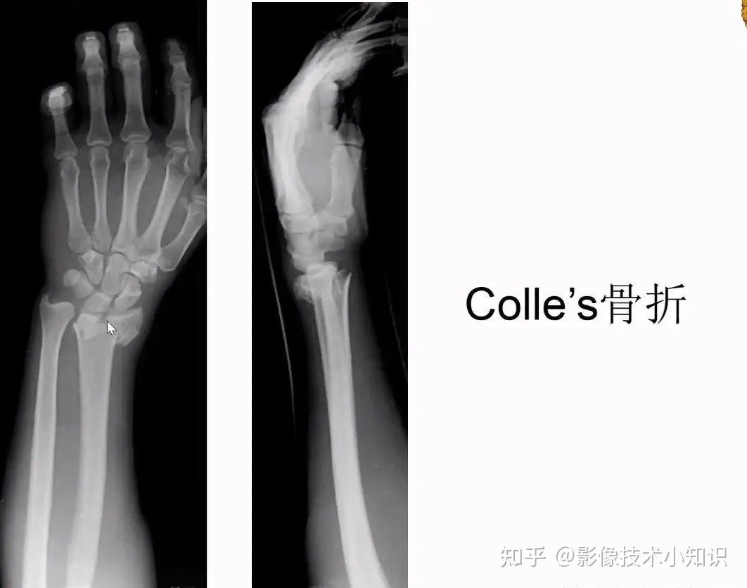 骨折影像表现（1） - 知乎