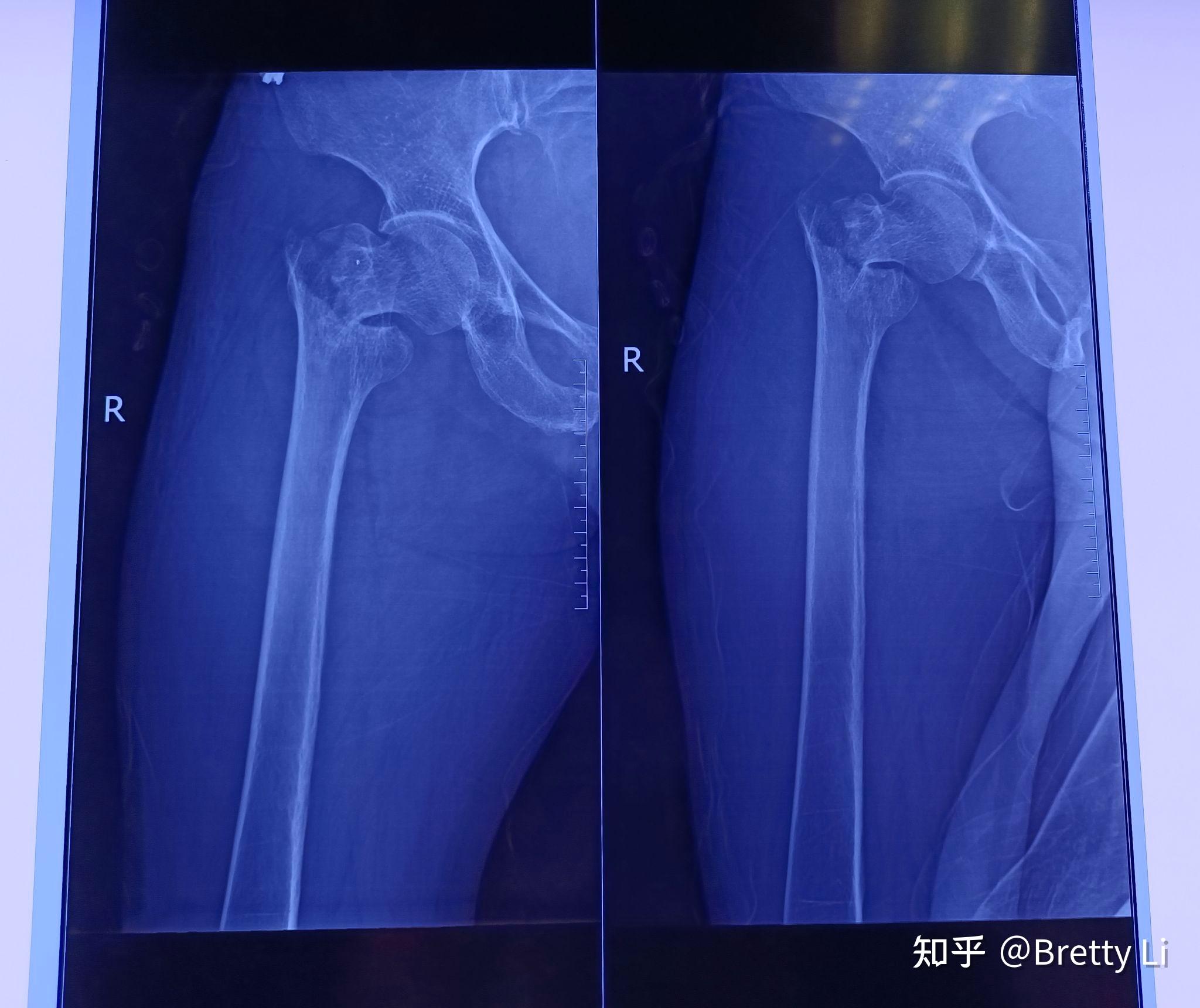 常见骨折类型X线片–探讨分析2 - 知乎