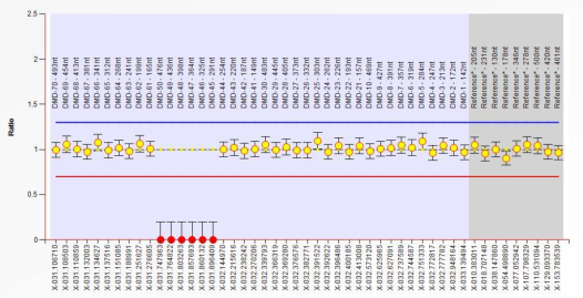 案例分享 | 基因检测助力罕见病诊断——杜氏肌营养不良症（DMD） - 知乎