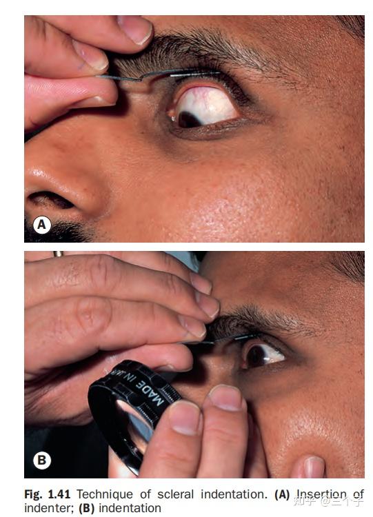No.19, Head-mounted binocular indirect opthalmoscopy - 知乎