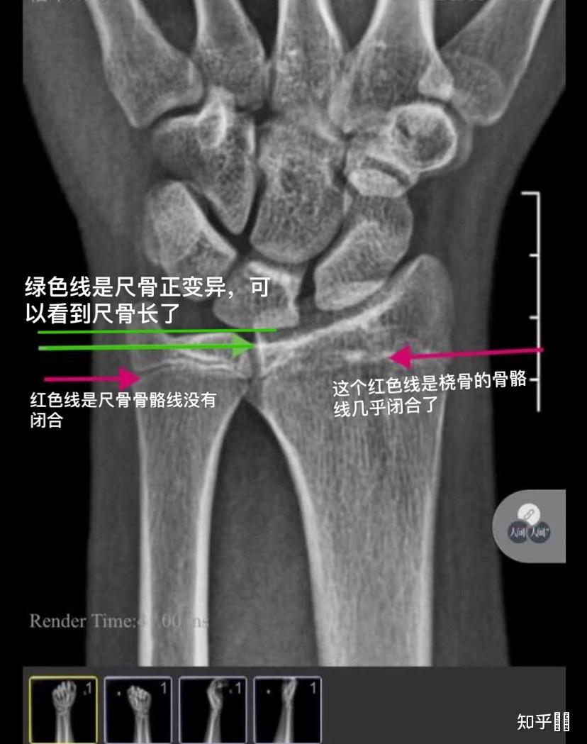 三角纤维软骨（tfcc）损伤，该如何治疗和康复呢？ - 知乎