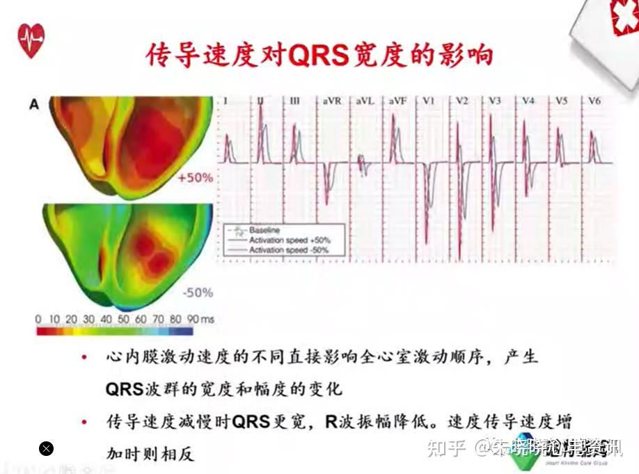 QRS波为什么会增宽？ - 知乎