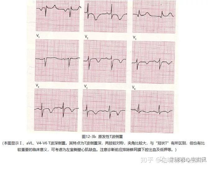 第十二讲：T波改变与心肌缺血 - 知乎