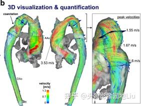 一起看懂4D FLOW MRI 参数（上） - 知乎