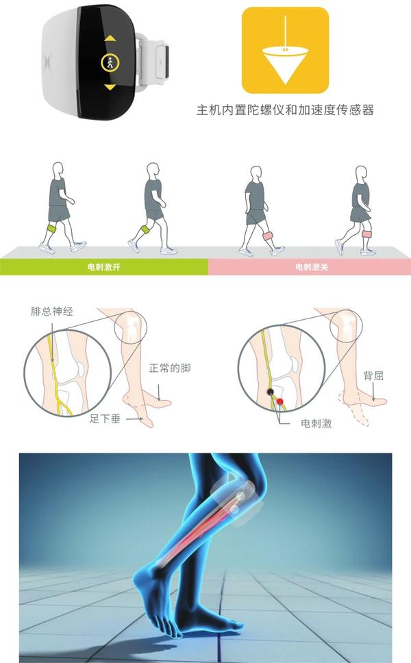 什么是功能性电刺激（FES）疗法 - 知乎