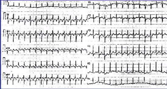 窄QRS波心动过速诊断与鉴别诊断 - 知乎