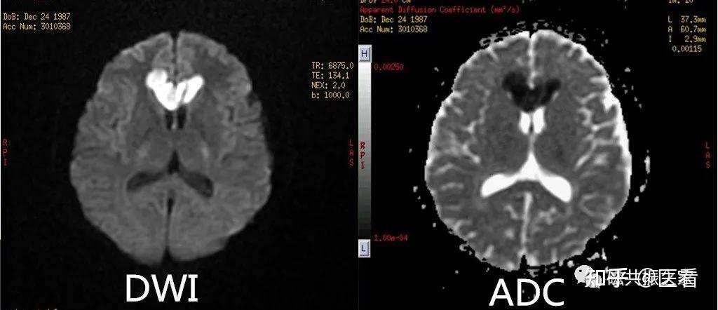 关于DWI，你必须弄清这几个问题 - 知乎