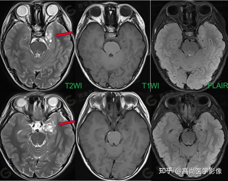 MRI诊断多结节和空泡状神经元肿瘤 - 知乎