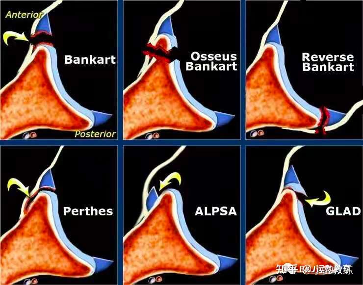 肩关节 - Bankart 损伤 - 知乎