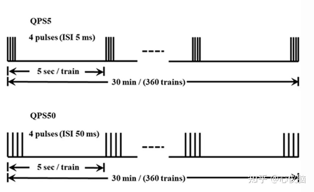 重复经颅磁刺激新方向——四脉冲刺激（QPS） - 知乎