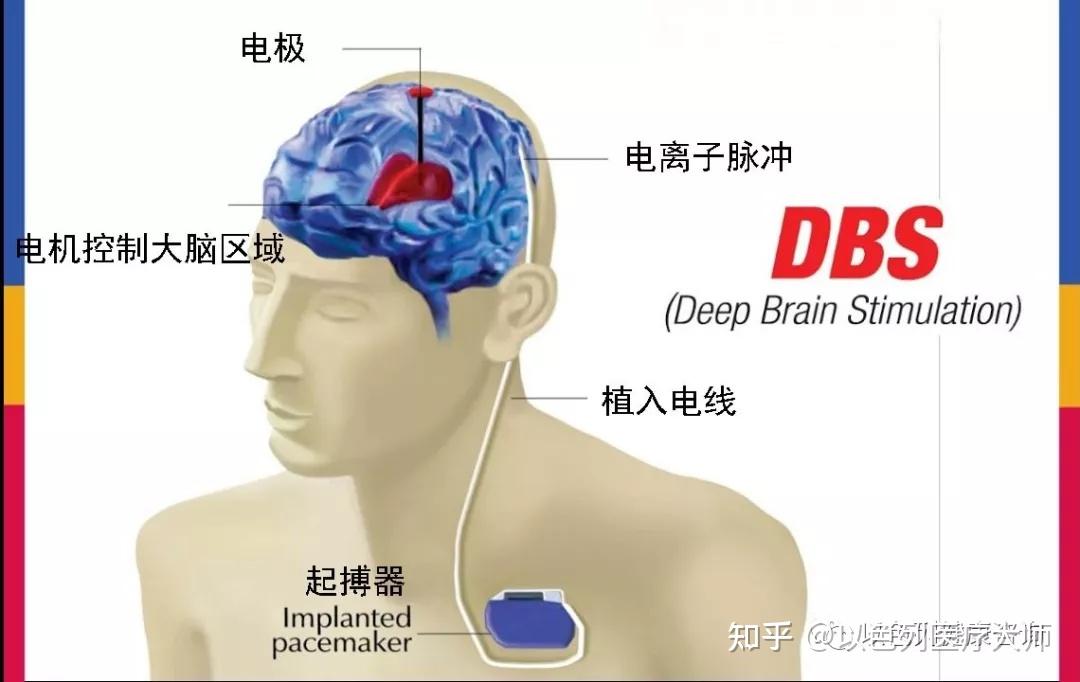 治疗原发性震颤——以色列聚焦超声治疗fus 知乎 8578