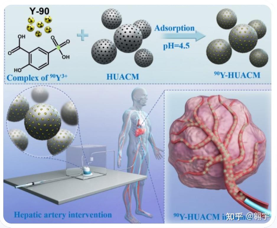 全球首例，癌王胰腺癌这次挨针扎了，钇[90Y]炭微球注射液是什么药？ - 知乎