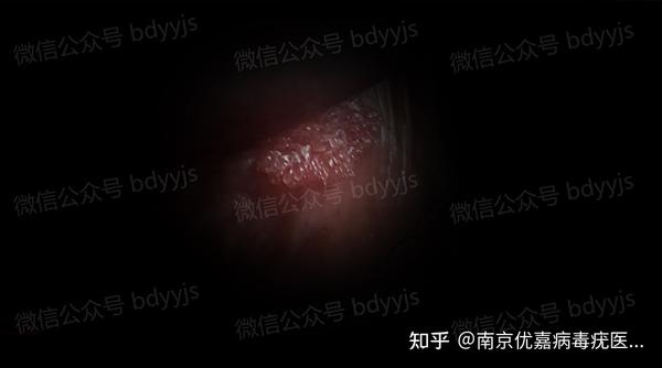 男性假疣和真疣的区别图 知乎