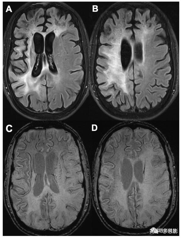 磁敏感加权成像（SWI)：技术要点和临床神经学应用 - 知乎