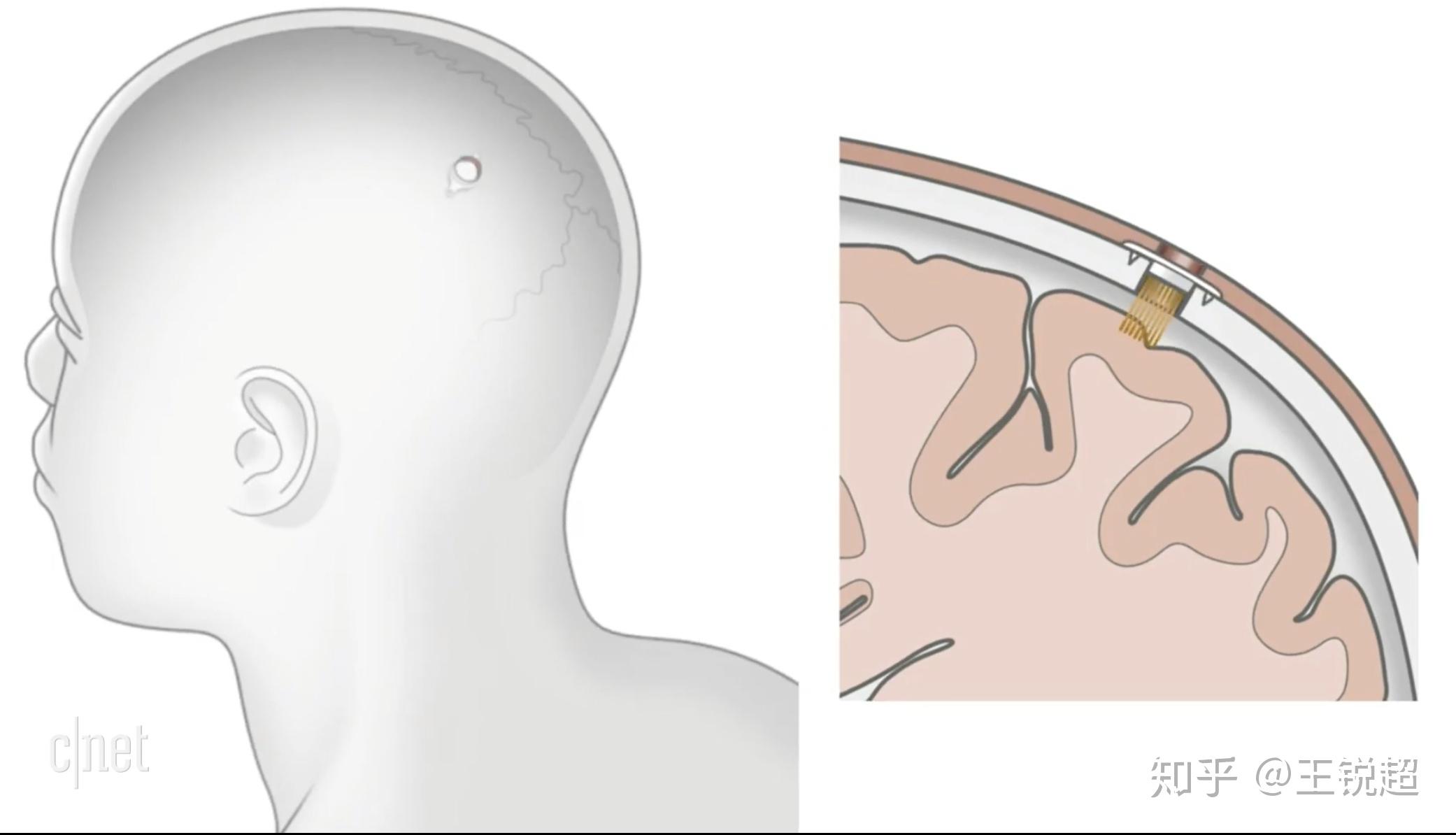 2020 年 侵入式脑机接口 （BCI）就已经初步实现了？？？ - 知乎