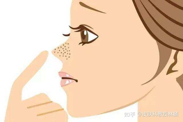 一个在家就能祛除 黑头”的妙招 知乎