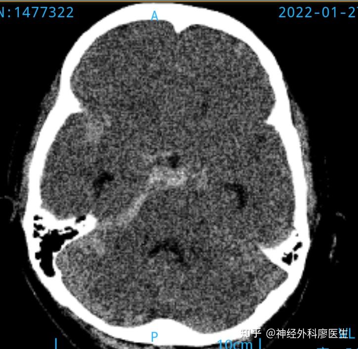 蛛网膜下腔出血术后预后要注意哪些问题 知乎 5207