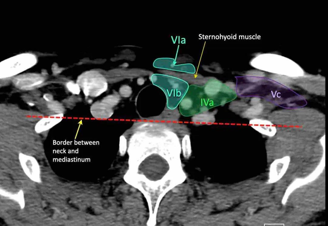 最全颈部淋巴分区图（CT轴位对照） - 知乎