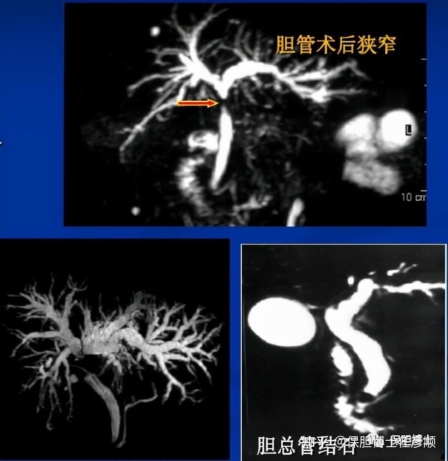 什么是MRCP，为什么要做这个检查？ - 知乎