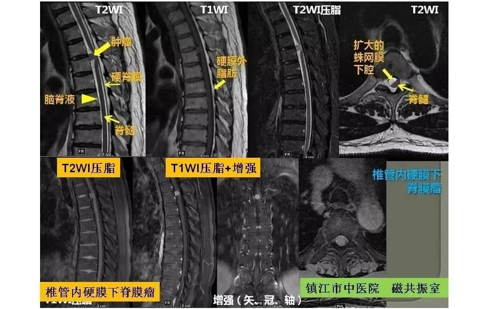 神内临床笔记56 正常颅脑MRI表现 - 知乎