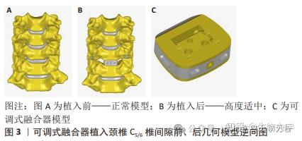 新型高度可调颈椎融合器的三维有限元分析 - 知乎