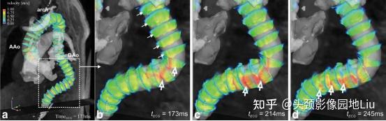 一起看懂4D FLOW MRI参数（下） - 知乎