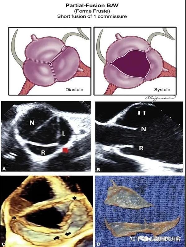二叶式主动脉瓣畸形之一 分型 - 知乎