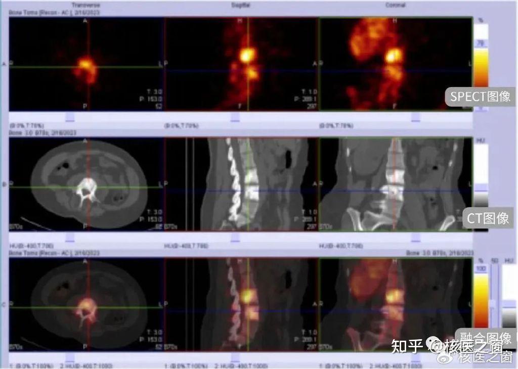 SPECT/CT临床应用 - 知乎