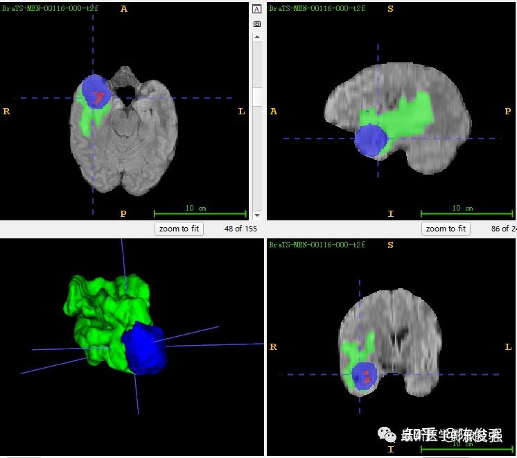 BraTS2023-MEN——BraTS2023颅内脑膜瘤分割挑战赛 - 知乎