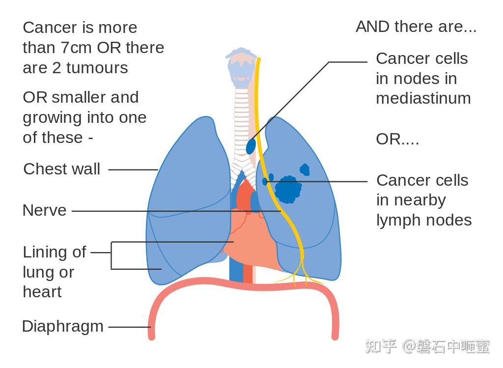 肺癌 Lung cancer - 知乎