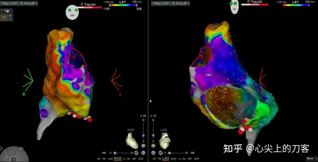 一文看懂心房扑动的射频消融术 - 知乎