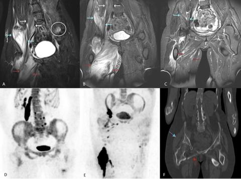 TMM of FOP-III. FOP的临床与基础科学背景-3.4 FOP的放射学特征 - 知乎