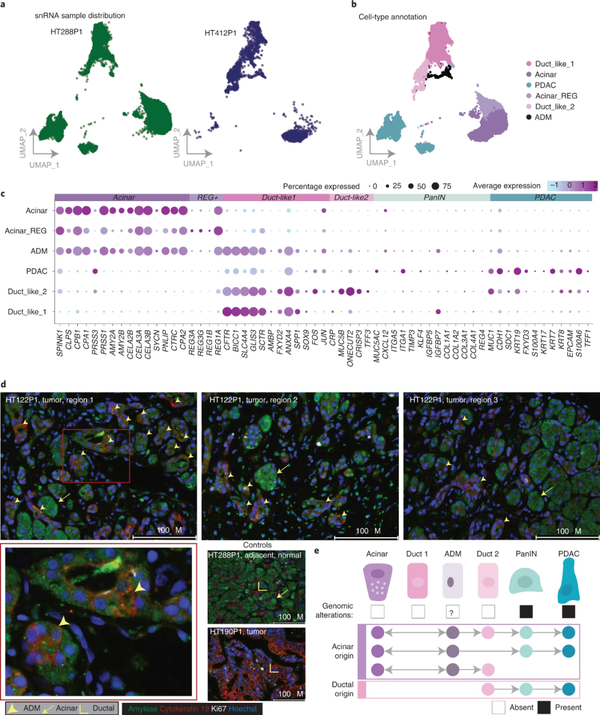 Nat Genetics | 胰腺癌肿瘤图谱网络连续动图揭示微环境与细胞亚群作用 - 知乎
