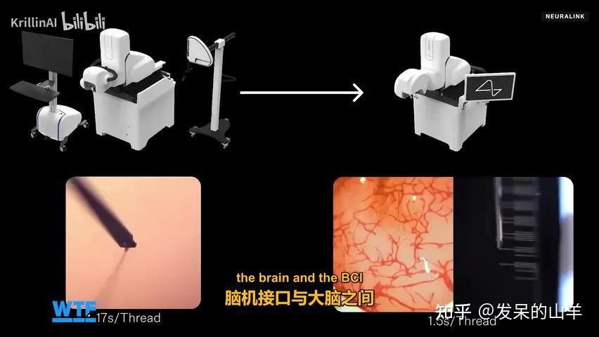 【前沿科学】脑机接口对决：Synchron vs Neuralink，谁能实现意念操控未来？ - 知乎