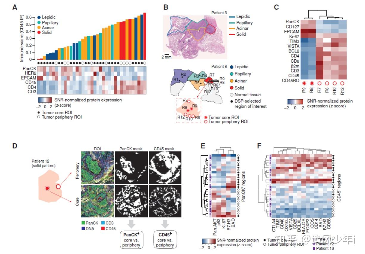单细胞 & DSP(Digital Spatial Profiler)联合分析解析肺腺癌的转录重编程推动cancer evolution - 知乎